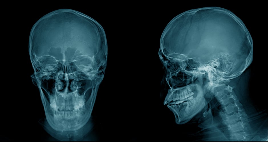 How Auto-Traction Straps Can Improve Diagnostic Accuracy in Cervical ...