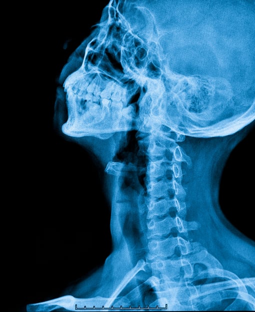 How Auto-Traction Straps Can Improve Diagnostic Accuracy in Cervical ...
